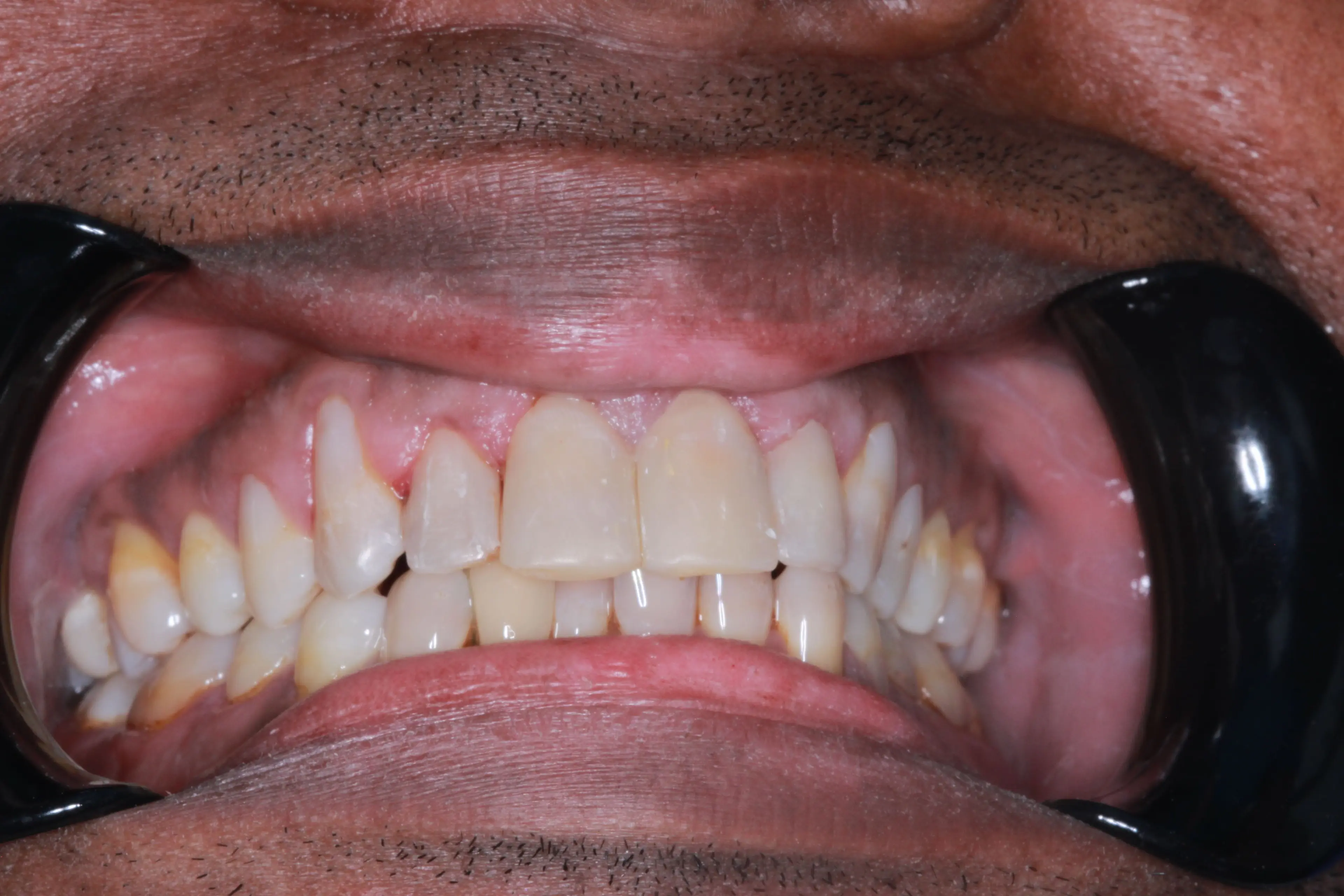 Successful Composite Bonding Case Study Stoke Dental